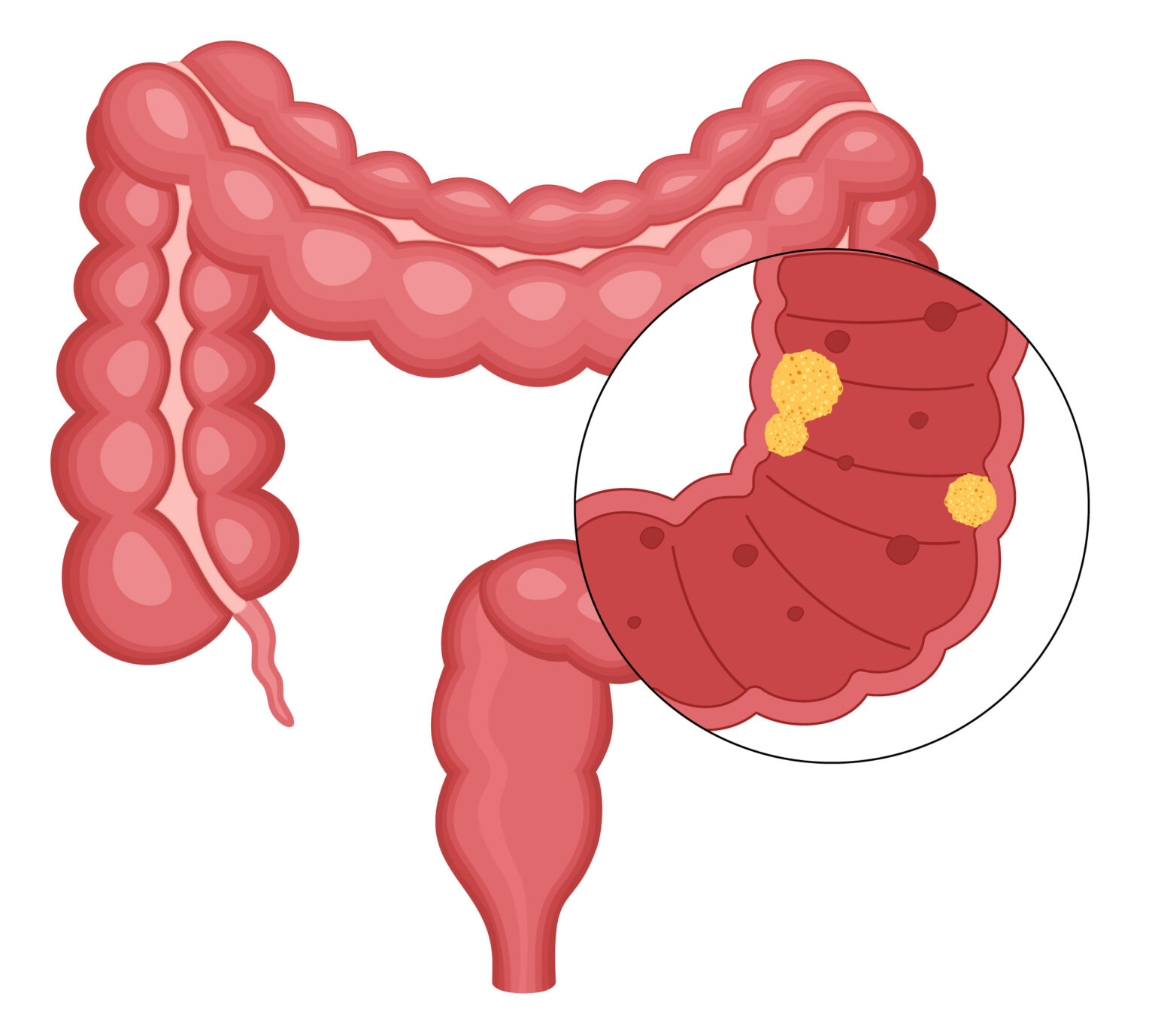 Darm: Kolorektale Chirurgie – Swiss1Chirurgie